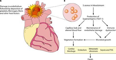 Staphylococcus Aureus Mitral Valve Endocarditis Due To Heel Decubitus