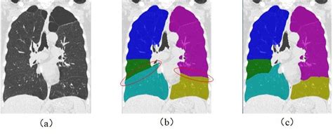 Picture Of Segmenting And Corrected Pulmonary Lobes From Pulmonary Download Scientific Diagram