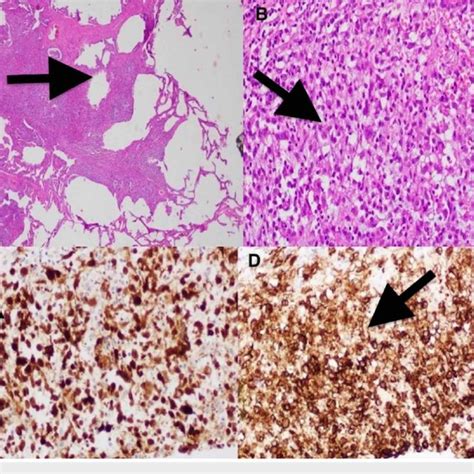 A Ct Chest Shows Diffuse Reticular And Nodular Interstitial Download Scientific Diagram