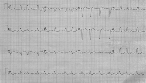 failed pacemaker detection of flecainide induced atrial flutter with one to one atrioventricular