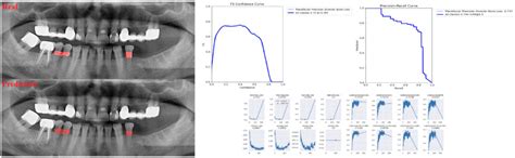 Assessing The Effectiveness Of Artificial Intelligence Models For Detecting Alveolar Bone Loss