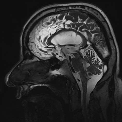 Endoscopic Third Ventriculostomy Encyclopedia Of Neuroendoscopic Procedures