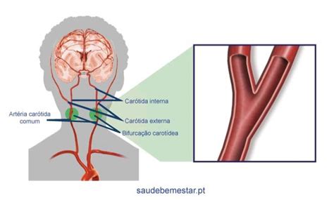 Orelha Da Arteria Carotida Interna Artéria Carótida Interna