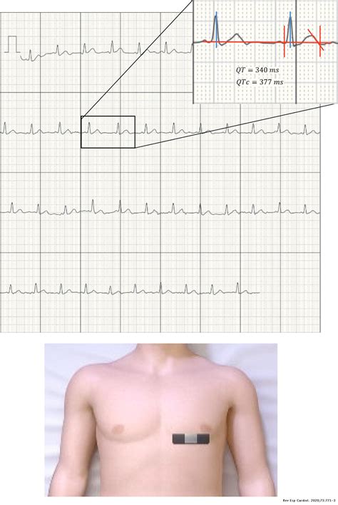 electrocardiographic qt interval monitoring with a portable device in