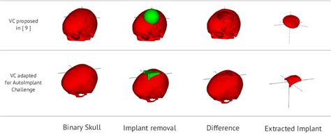 Modified Virtual Craniectomy Procedure We Incorporated New Template Download Scientific