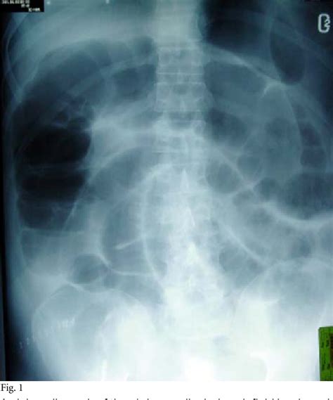 Figure 1 From Acute Colonic Pseudo Obstruction Ogilvie Syndrome After