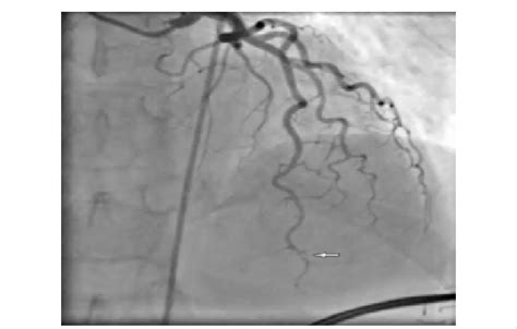 Distal 70 Left Anterior Descending Artery Stenosis On Angiogram Download Scientific Diagram