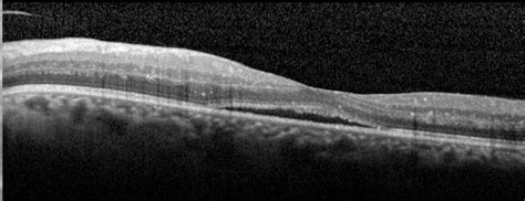 Oct Image Showing Subretinal Fluid Endotext