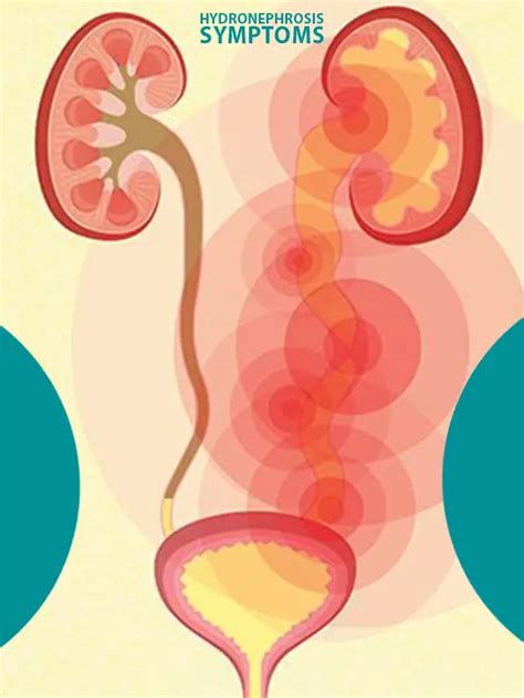 8 Basic Hydronephrosis Symptoms And Signs