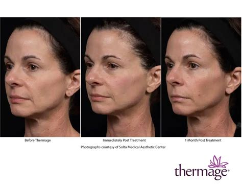 Thermage® Dr Lee B Daniel