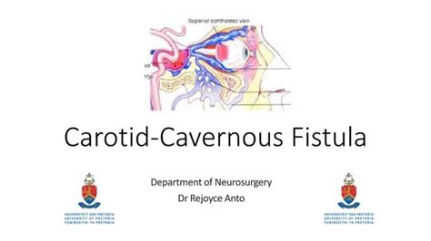 Carotid Cavernous Fistulas Pptx