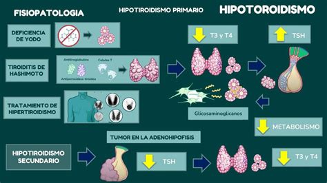 Hipotiroidismo Jksh Udocz