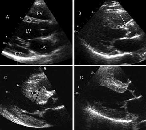 Abnormal Echocardiogram Results