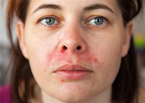 Facial Eczema Understanding Causes Treatment And Care