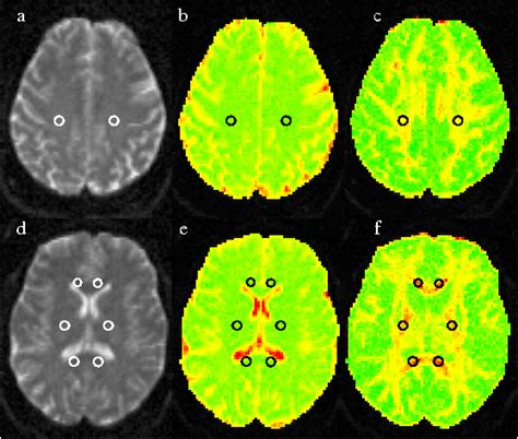 Diffuse Axonal Injury Semantic Scholar