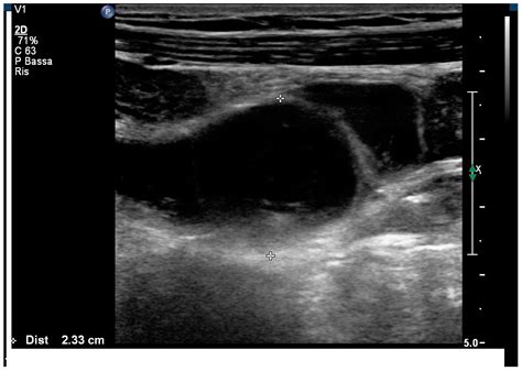 Eosinophilic Gastroenteritis With Appendix Involvement Role Of