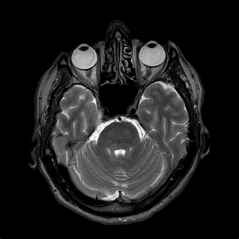 Mrt Orbita Mrt Des Auges Aristra