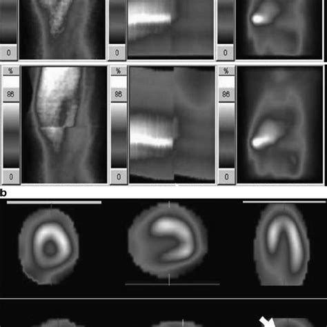 Pdf Motion Correction And Myocardial Perfusion Spect Using Manufacturer Provided Software