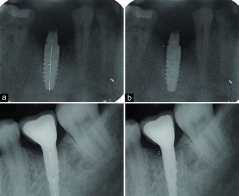 Bone Loss Calculated By Linear Measurements Of Implant And Crestal Bone Download Scientific