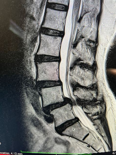 This 64 Year Old Woman Presented With Severe Neurogenic Claudication