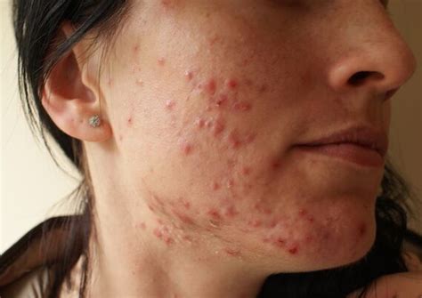 Demodex Symptons Demodex And Rosacea Treatment