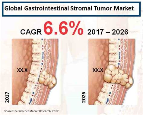 Global Gastrointestinal Stromal Tumor Market Industry Analysis Size