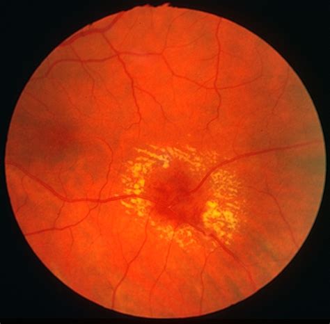 Retinal Arterial Macroaneurysm Retina Image Bank