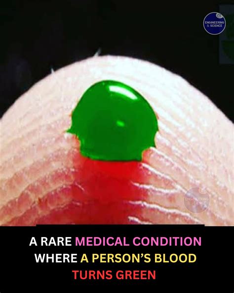 Engineering And Science Sulfhemoglobinemia Is A Rare Medical Condition In Which An Excessive