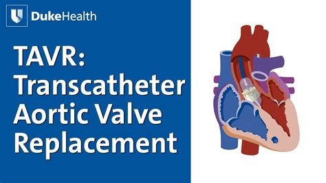 Tavr Valve Edwards At Julia Belcher Blog