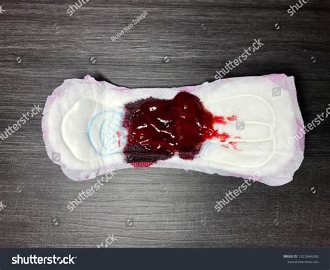 Clots During Menstruation