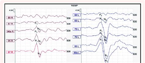 Asymmetry In The Amplitude Responses Response Threshold Abnormally Download Scientific Diagram