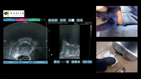 Spaceoar Injection With Koelis Trinity And Precisionpoint Transperineal Access System Youtube