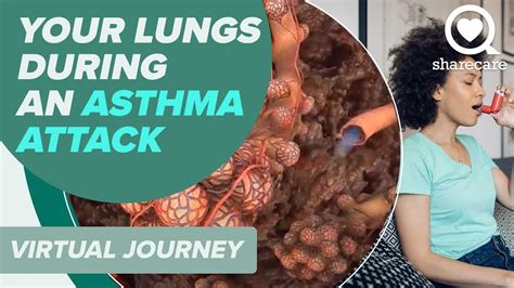 What Happens In Your Lungs During An Asthma Attack 360 Video Youtube