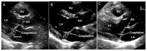 Two Dimensional Transthoracic Echocardiogram In The Parasternal Long