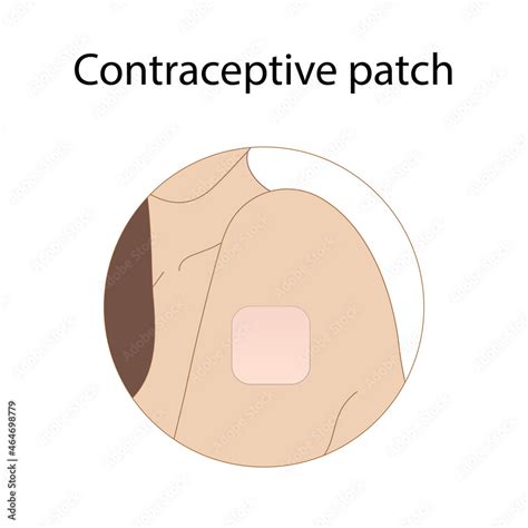Contraceptive Patch
