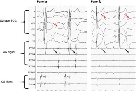 Laa Activity Morphologies After Laa Isolation A Spontaneous Laa
