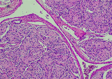 200 Fotos Bilder Und Lizenzfreie Bilder Zu Meningeom Fotos Istock