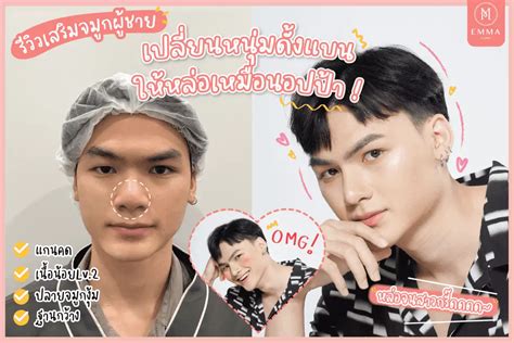 รีวิวเสริมจมูกผู้ชาย เปลี่ยนหนุ่ม “ดั้งแบน” ให้ดูหล่อ“อปป้า”
