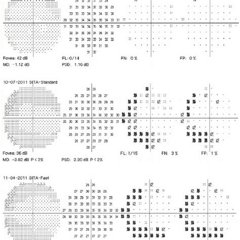 Pdf Scotoma Analysis Of 10 2 Visual Field Testing With A Red Target