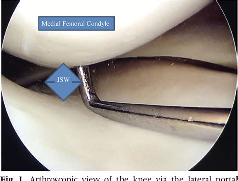 Figure 1 From The Role Of The Pie Crusting Technique Of The Medial Collateral Ligament In The