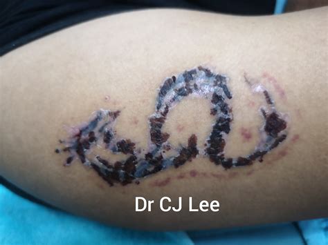 Peeling Tattoo Scab