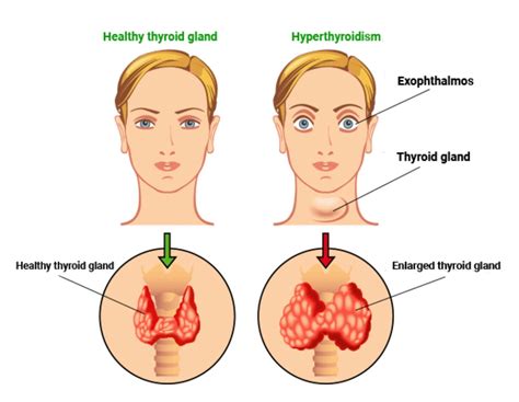 Disrupted Thyroid Navigating The Complexities Of Hormonal Balance