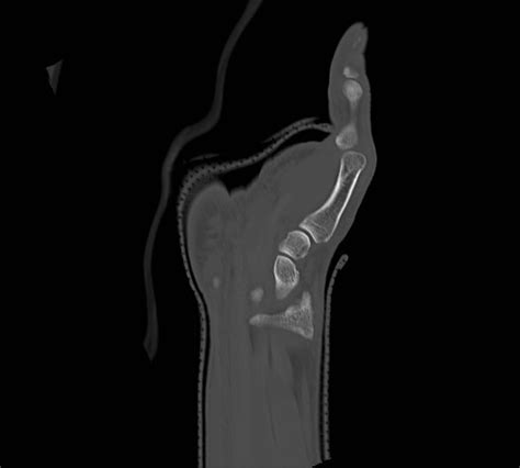 Radiopaedia Case Extensor Carpi Radialis Longus Avulsion Fracture Id