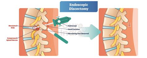 Endoscopic Decompression Surgery In India Types And Recovery Time