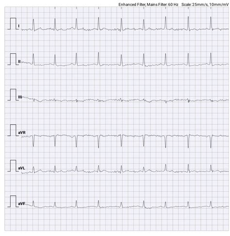 Kardia Ecg Normal With Wide Qrs R Readmyecg