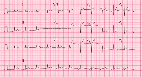 Ectopic Atrial Tachycardia Arrhythmias Cardiovascular