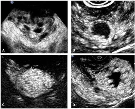 The Four Enhancement Patterns A Diffuse Enhancement B Regional