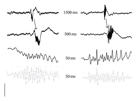 Representative Intracranial Eeg Recordings Taken Before Drug Download Scientific Diagram