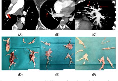 Figure 1 From Sex Differences In Chronic Thromboembolic Pulmonary