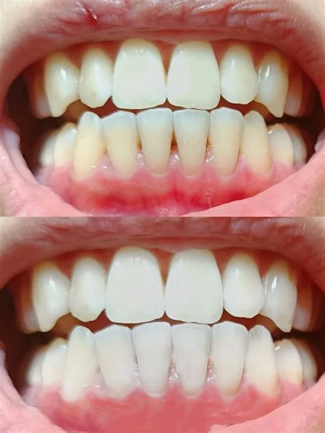 刷到就是赚到，牙龈萎缩的姐妹码住！ 小红书 花瓣网